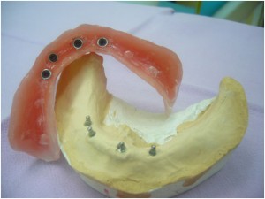Protetika « Stomatolog Pančevo – Dr Gerga – Dental Art Studio